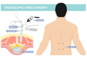 Endoscopic Spine Surgery In Dubai | Dr Challali Maxime