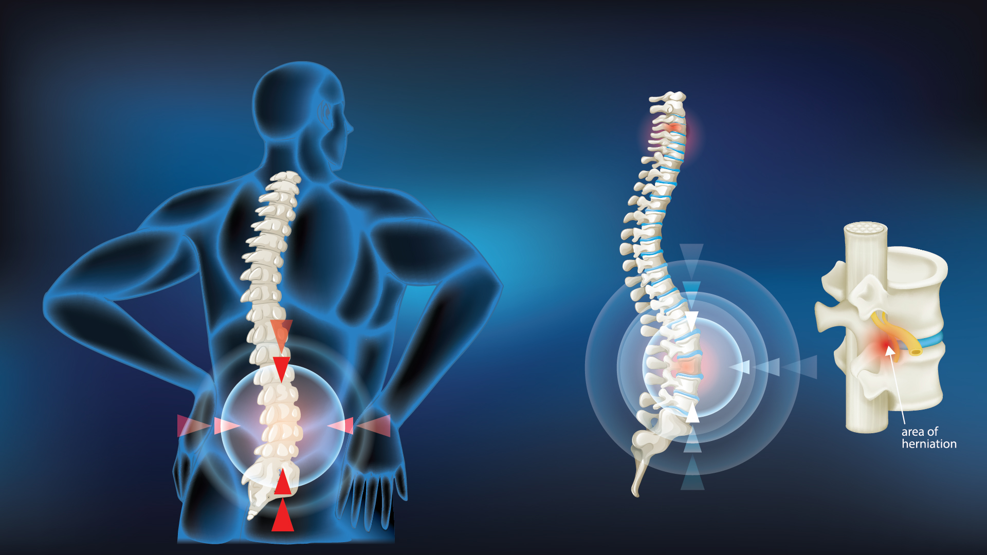 Advanced Spine Treatments In Dubai | Dr. Challali Maxime